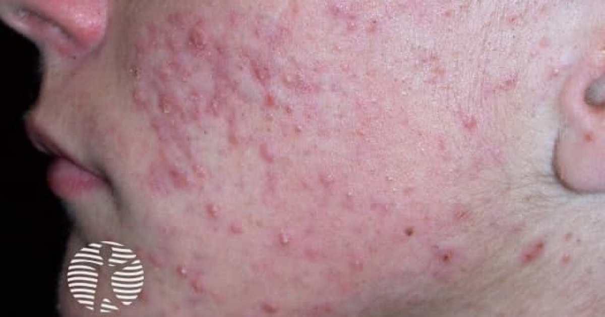 acne-face_2_18 image