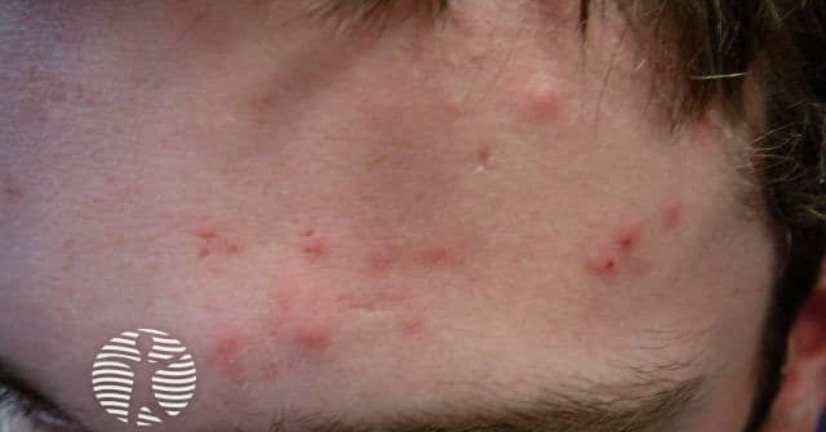 DermNet® - acne-face_2_24 image