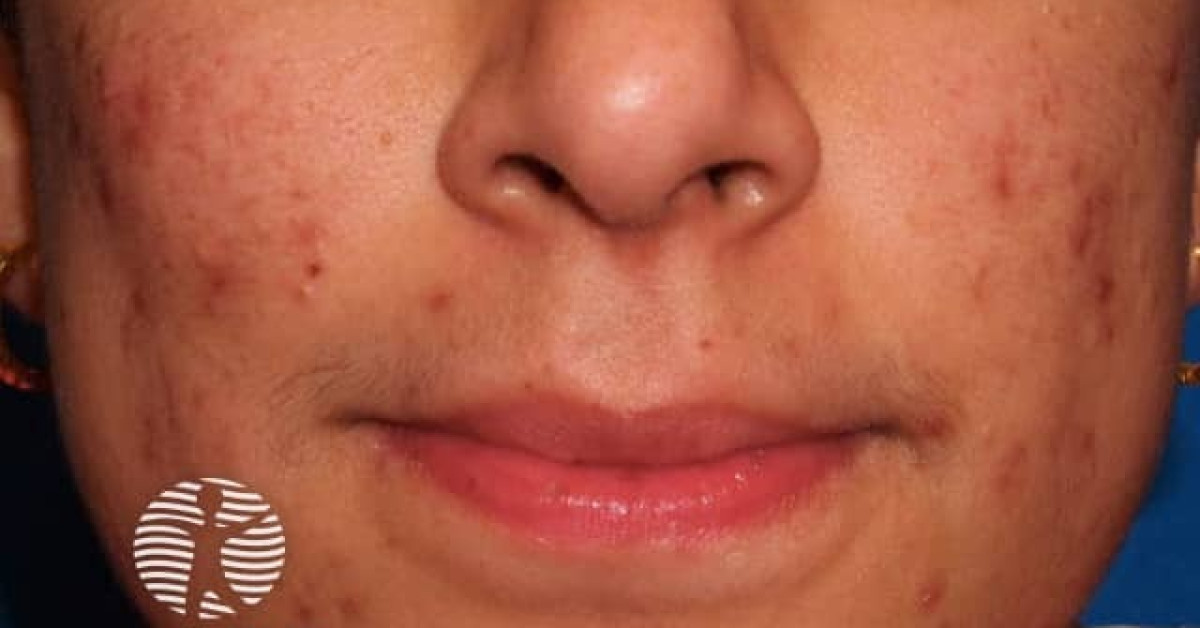 acne-face_2_4 image