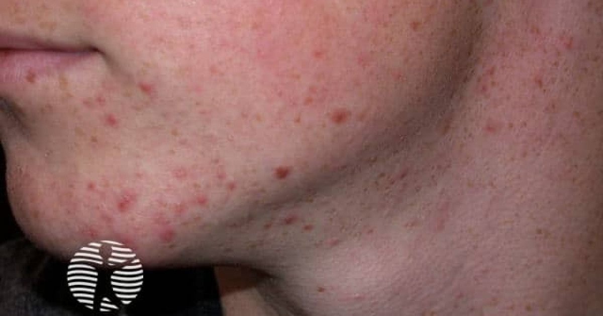 DermNet® - acne-face_2_7 image