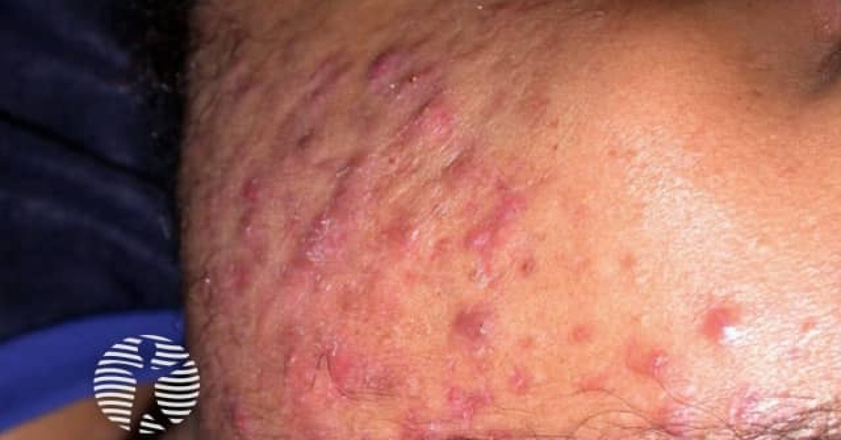 Facial acne image
