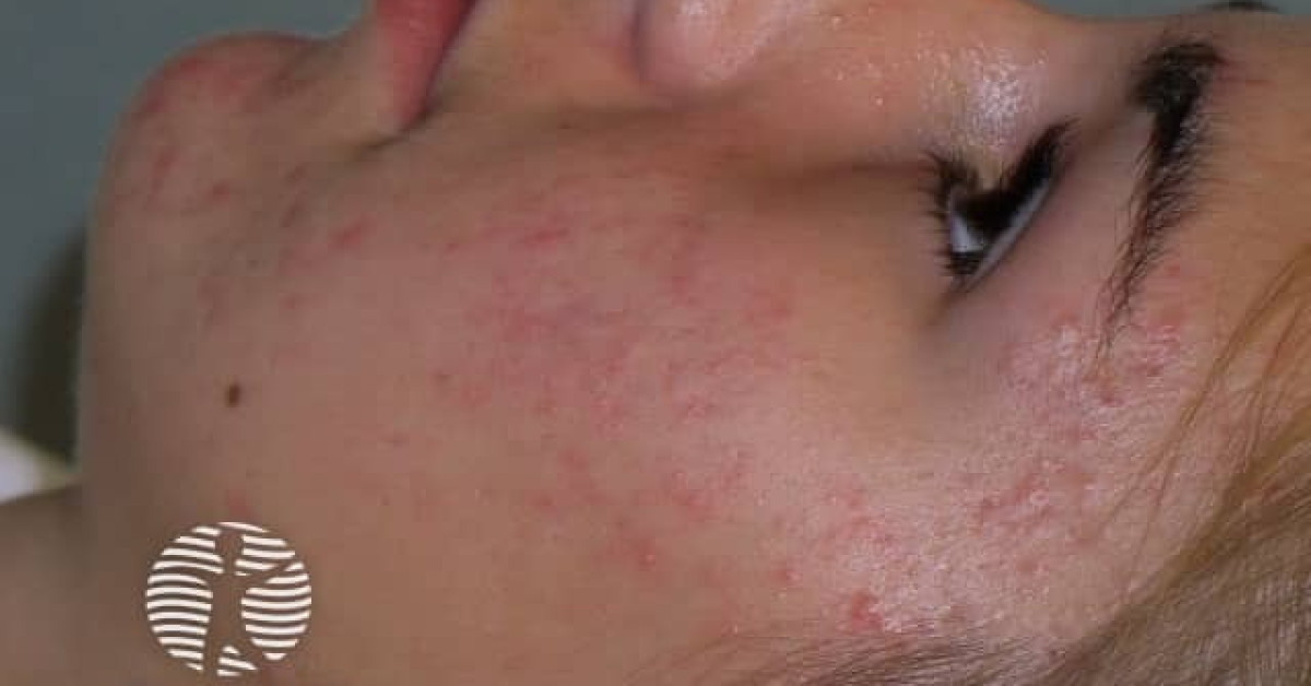 DermNet® - acne-face_3_10 image