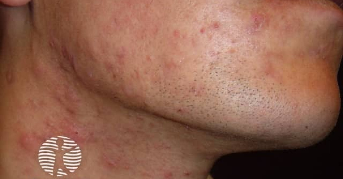 DermNet® - acne-face_3_12 image