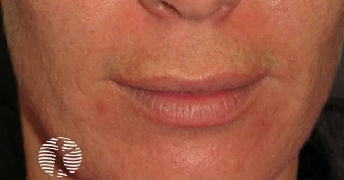 DermNet® - Skin phototype 3 image