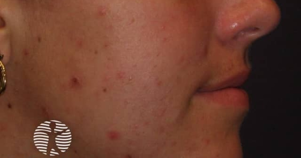 DermNet® - acne-face_3_22 image