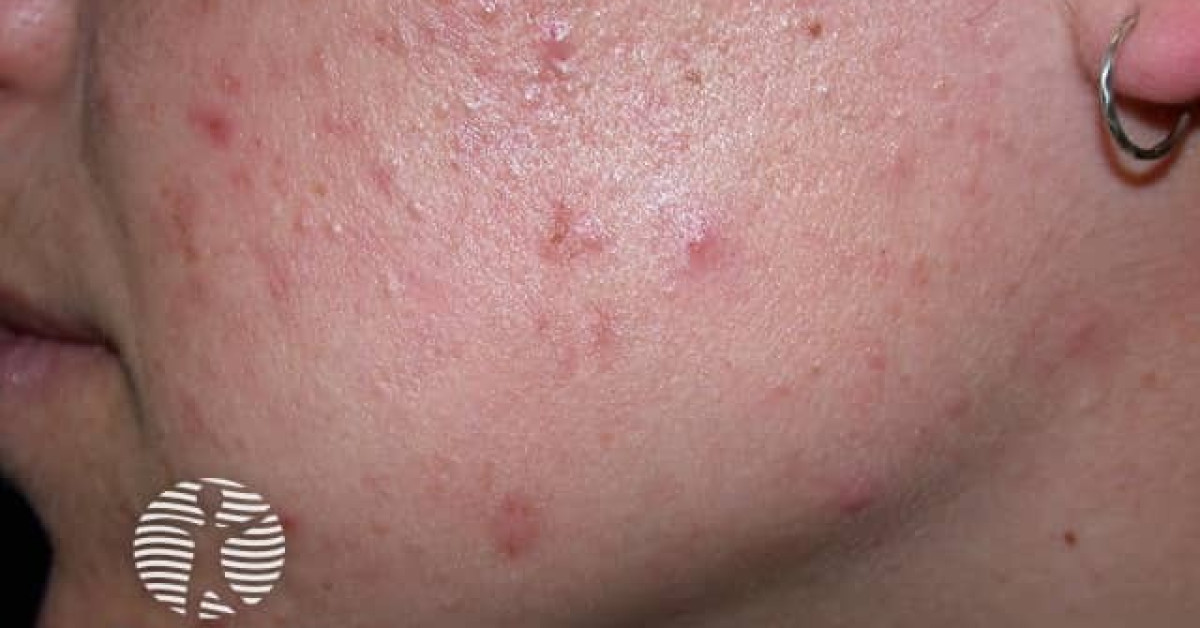 DermNet® - Facial acne image