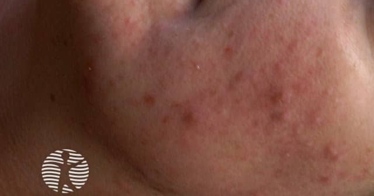 DermNet® - acne-face_4_11 image