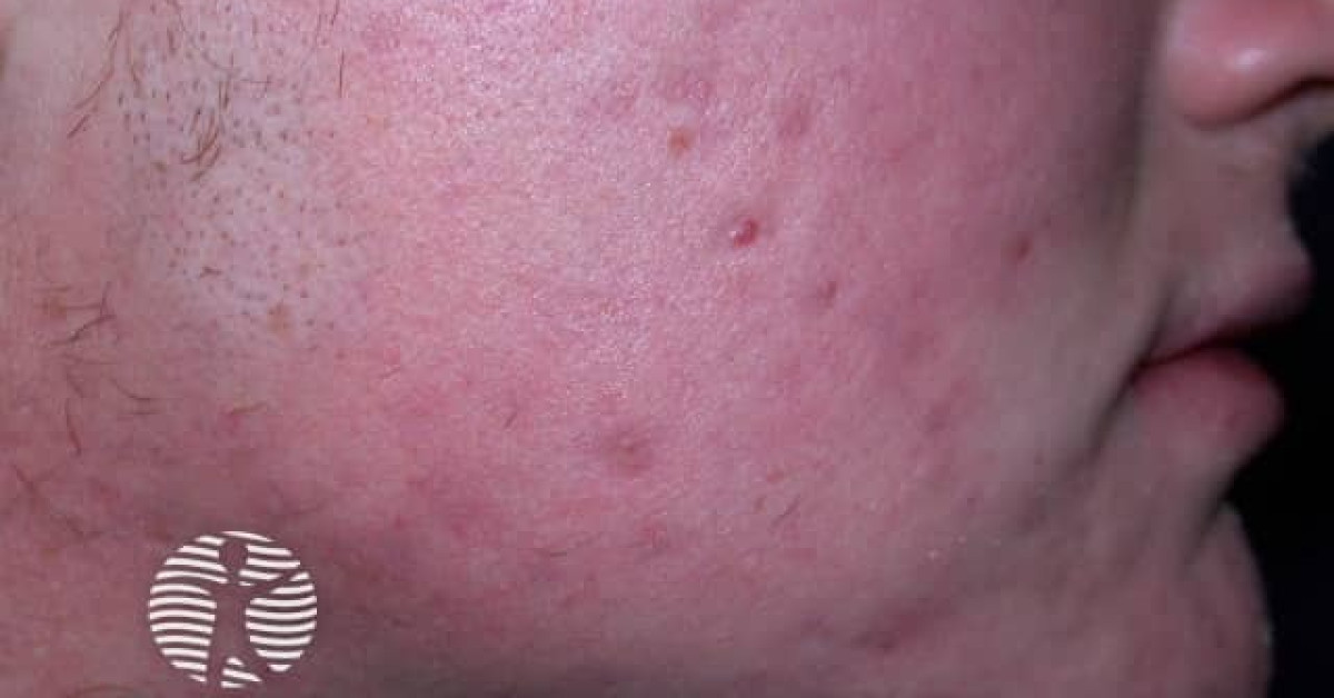 DermNet® - acne-face_40 image