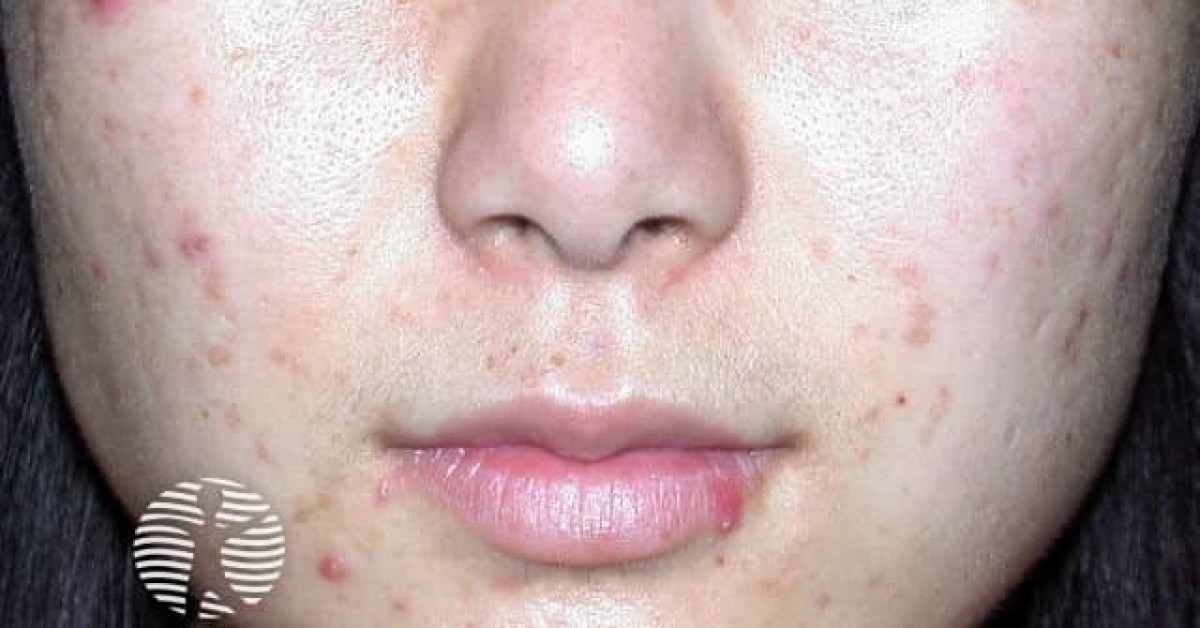 DermNet® - acne-face_43 image