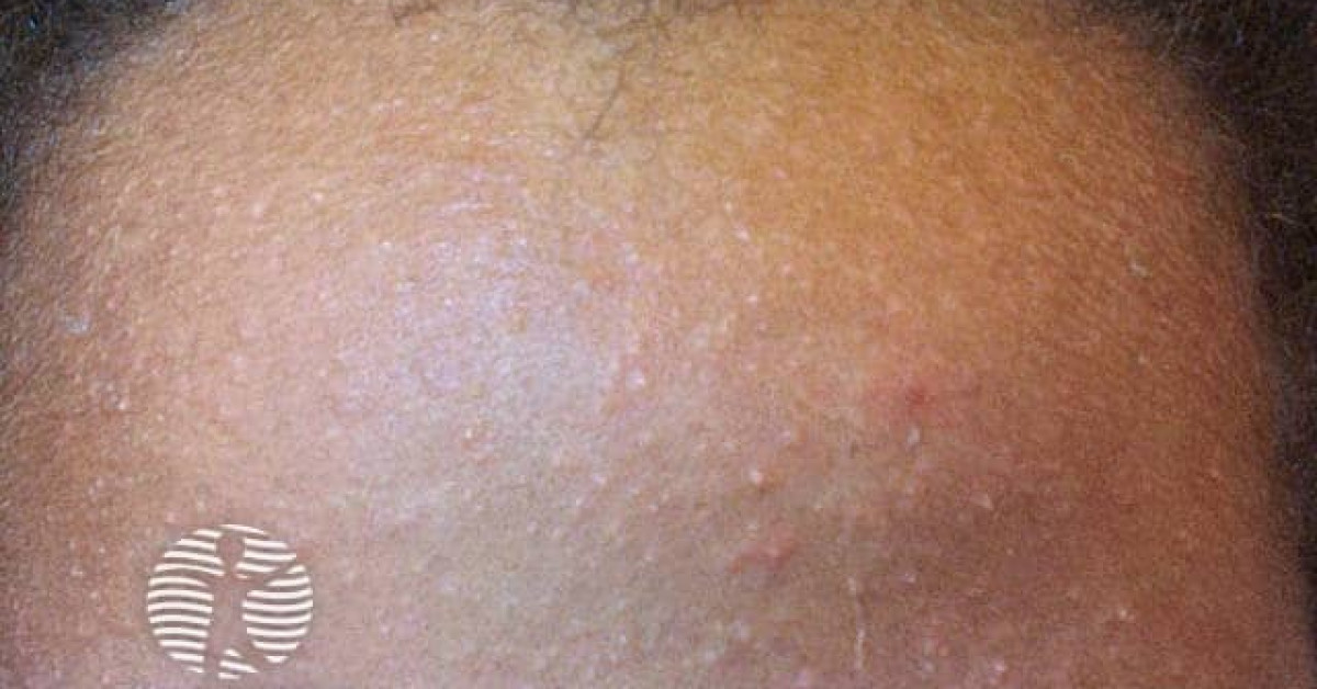 DermNet® - Facial acne image