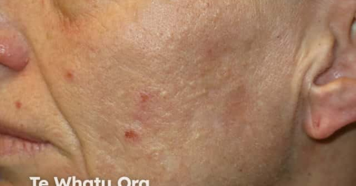 DermNet® - acne-face_5_8 image