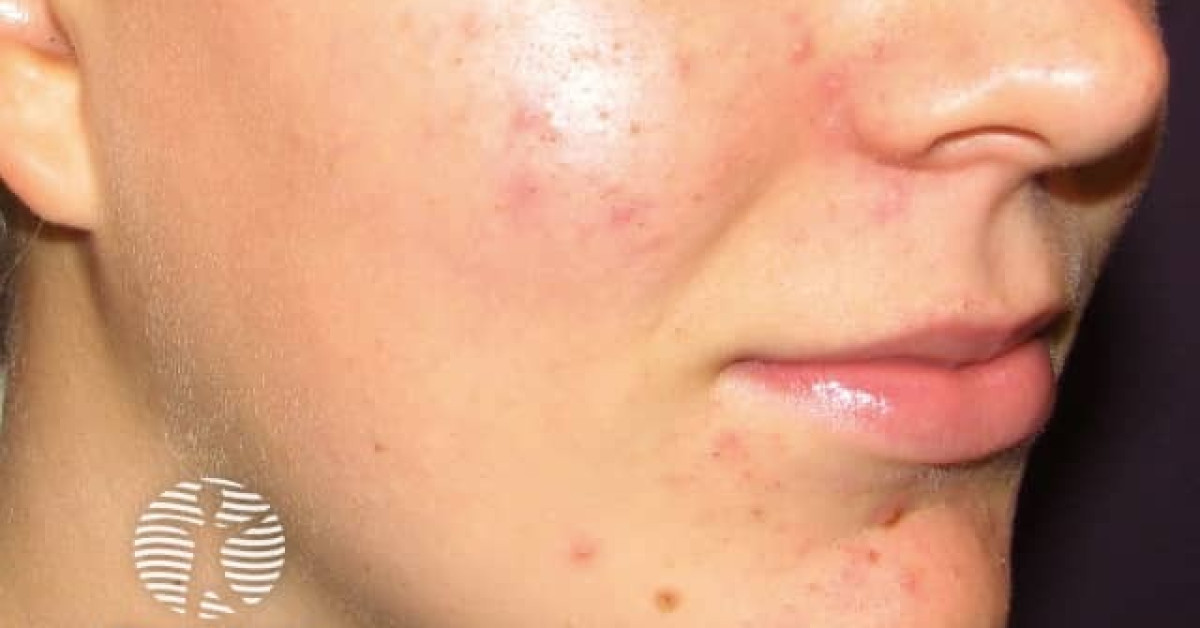 acne-face_6_4 image