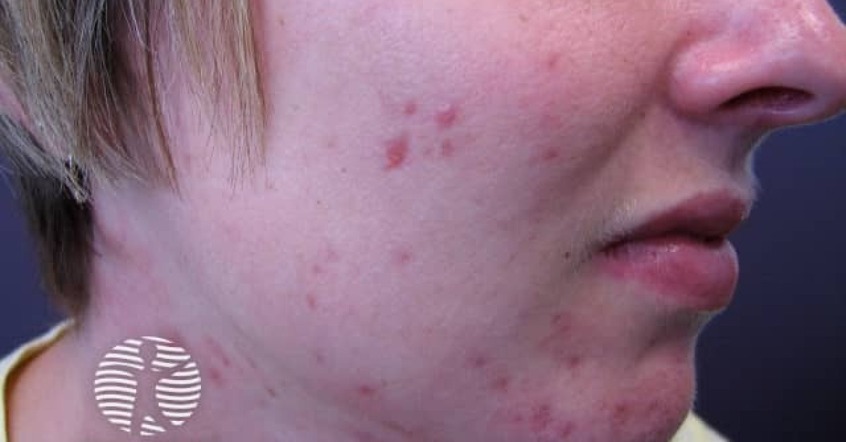 DermNet® - acne-face_70 image