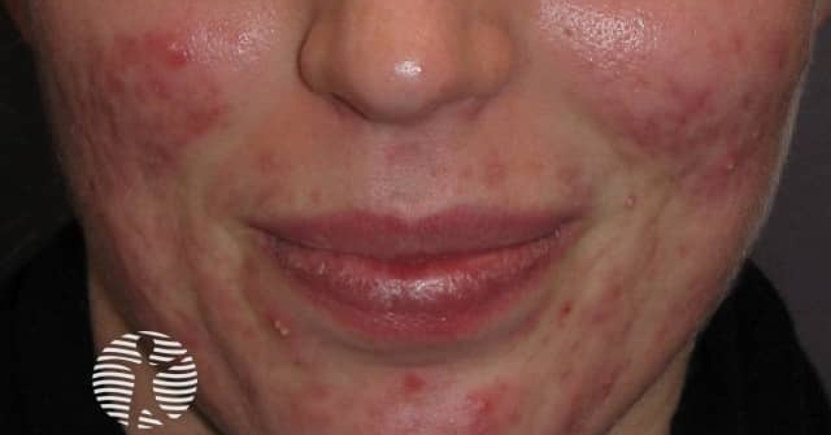acne-face_74 image