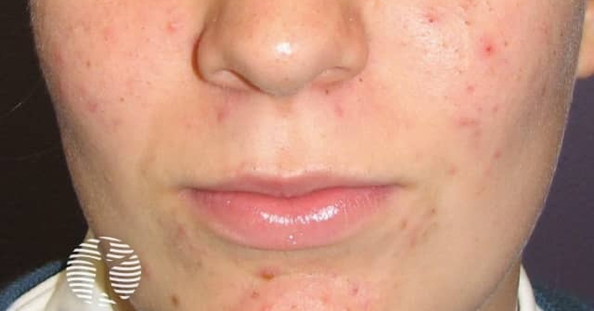 acne-face_8_3 image