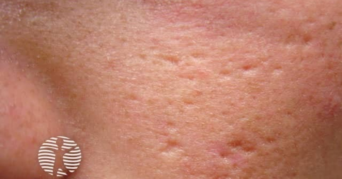 Scarring from infantile acne image