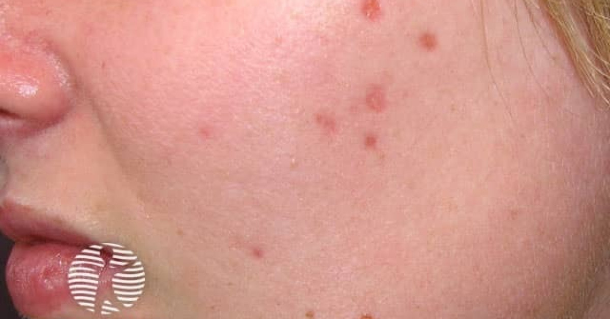 Acne: pink marks image