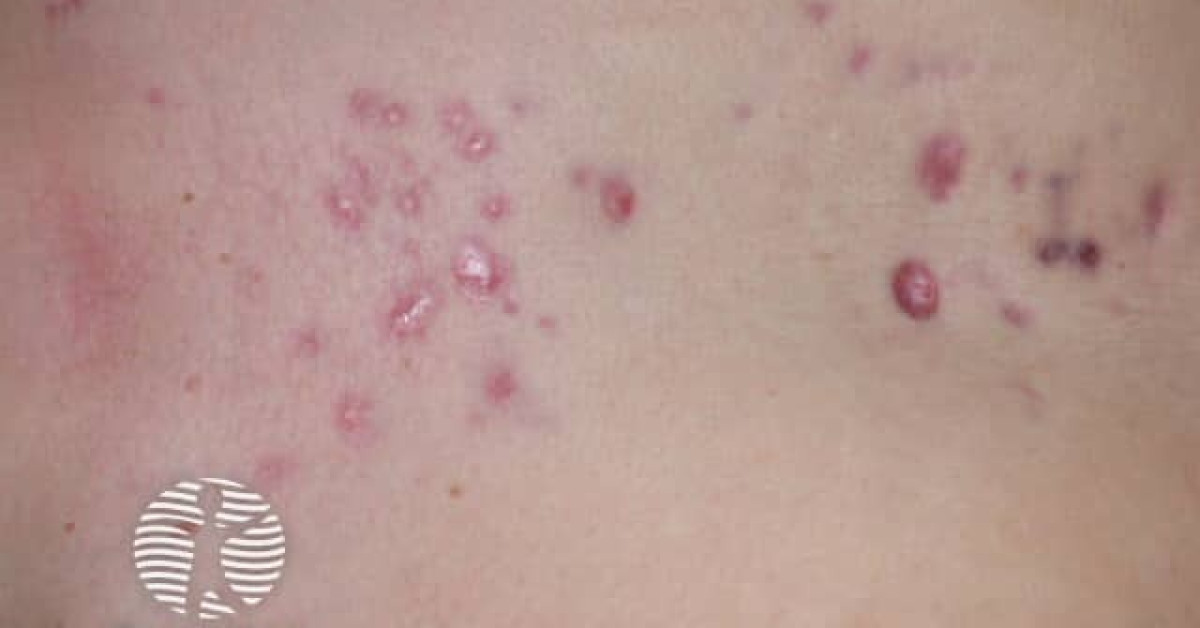 DermNet® - Acne scars image