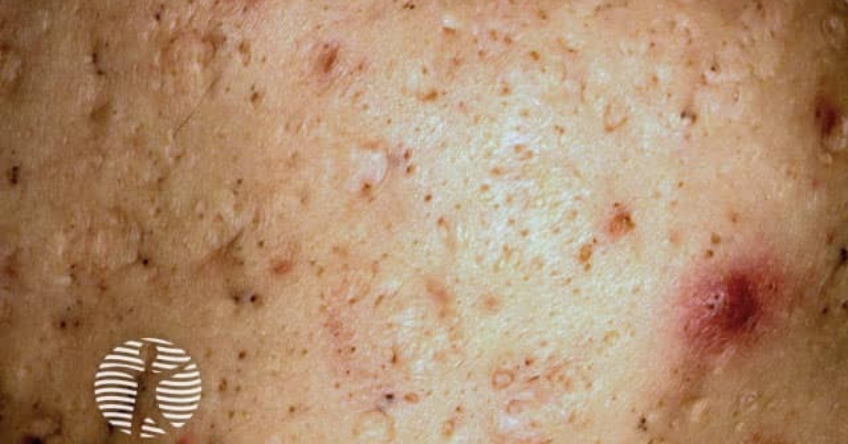 Ice-pick acne scars image