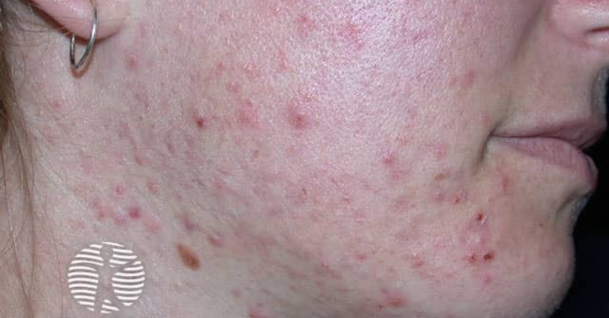 DermNet® - Acne vulgaris image