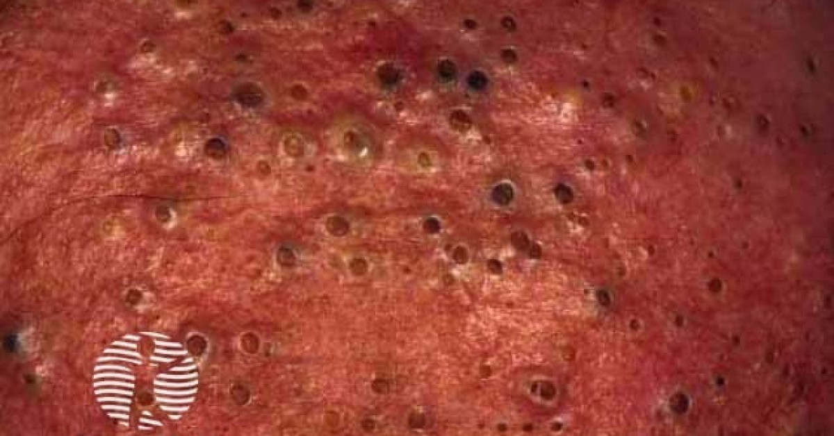 Cloracne image