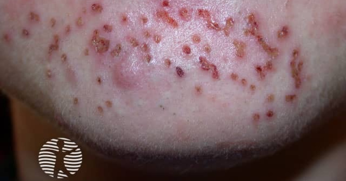 Electrosurgery to comedones image