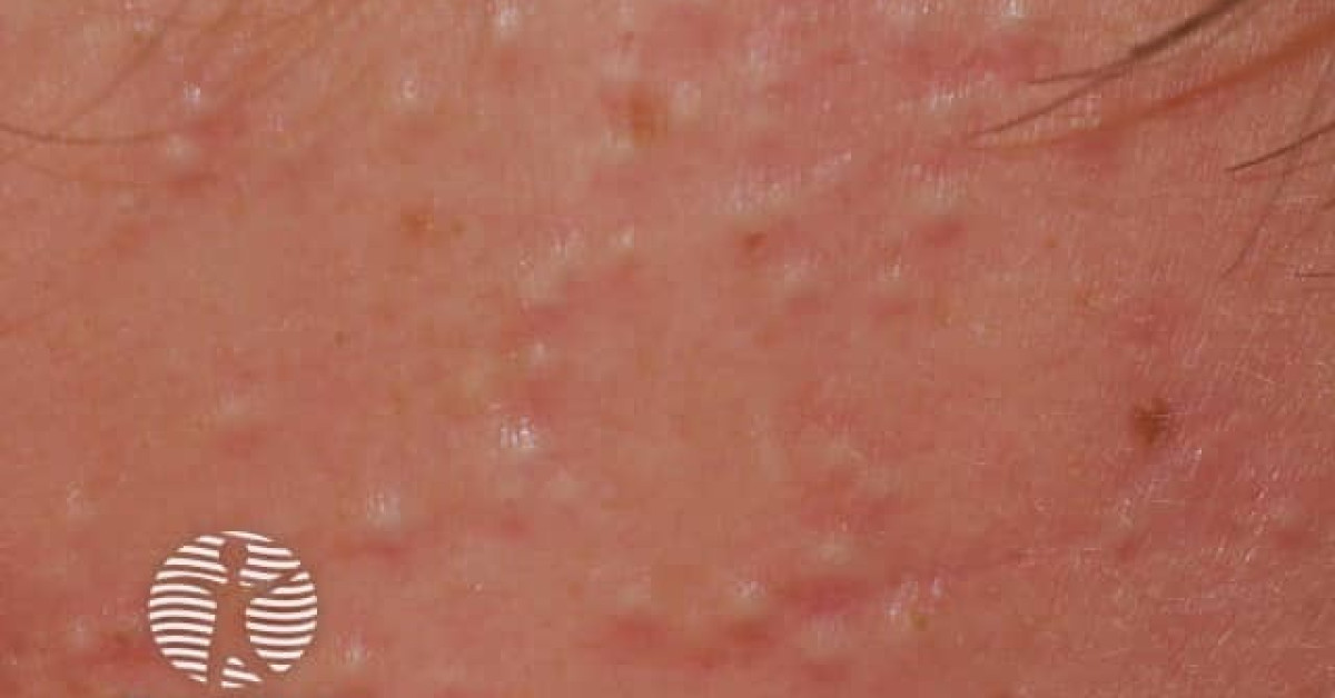 Comedonal acne image