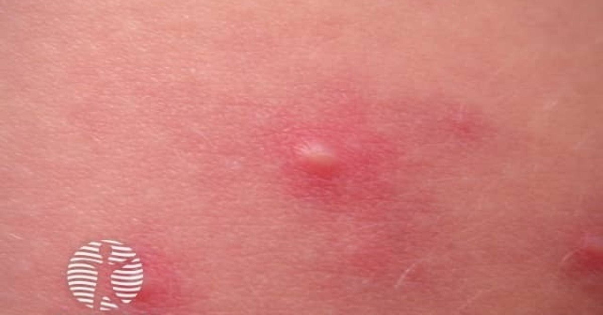 Folliculitis image