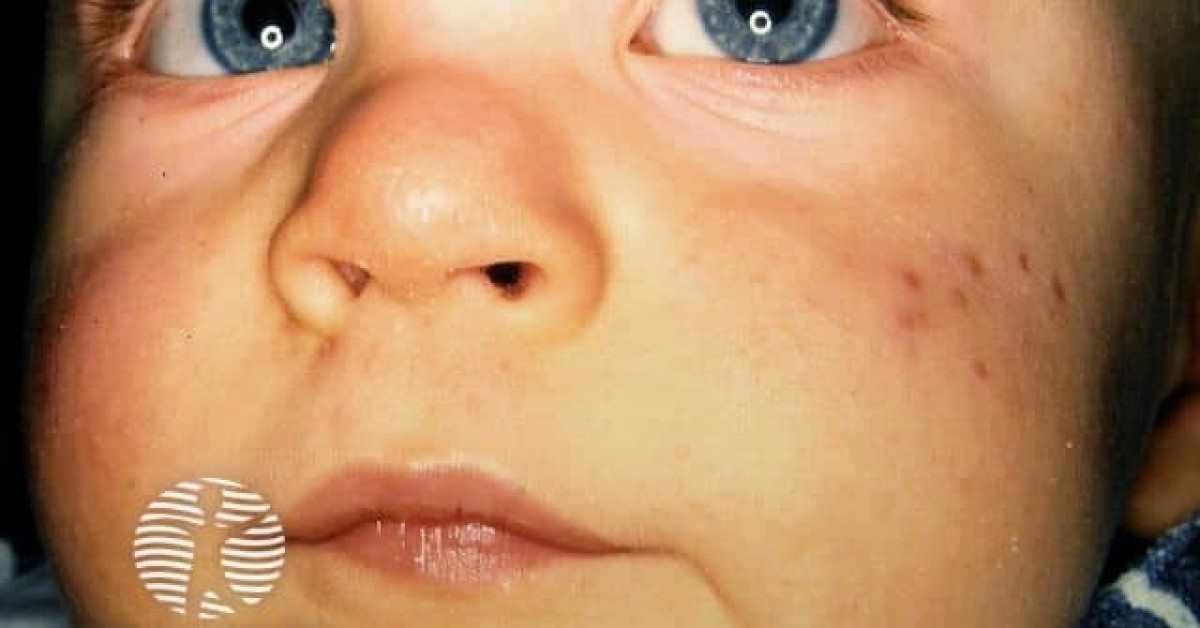 Infantile acne image