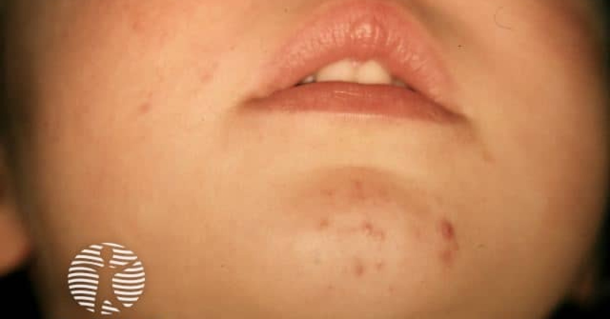 Infantile acne image