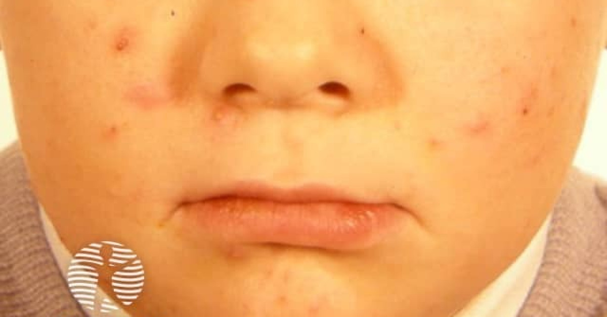 Infantile acne image