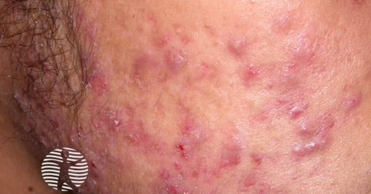 DermNet® - Acne image