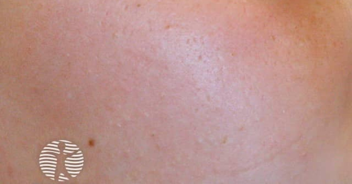 Atrophoderma vermiculata image