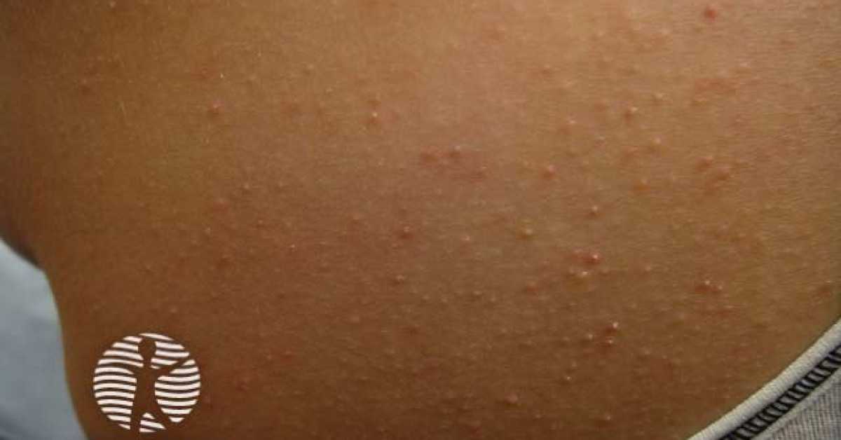 Keratosis pilaris image