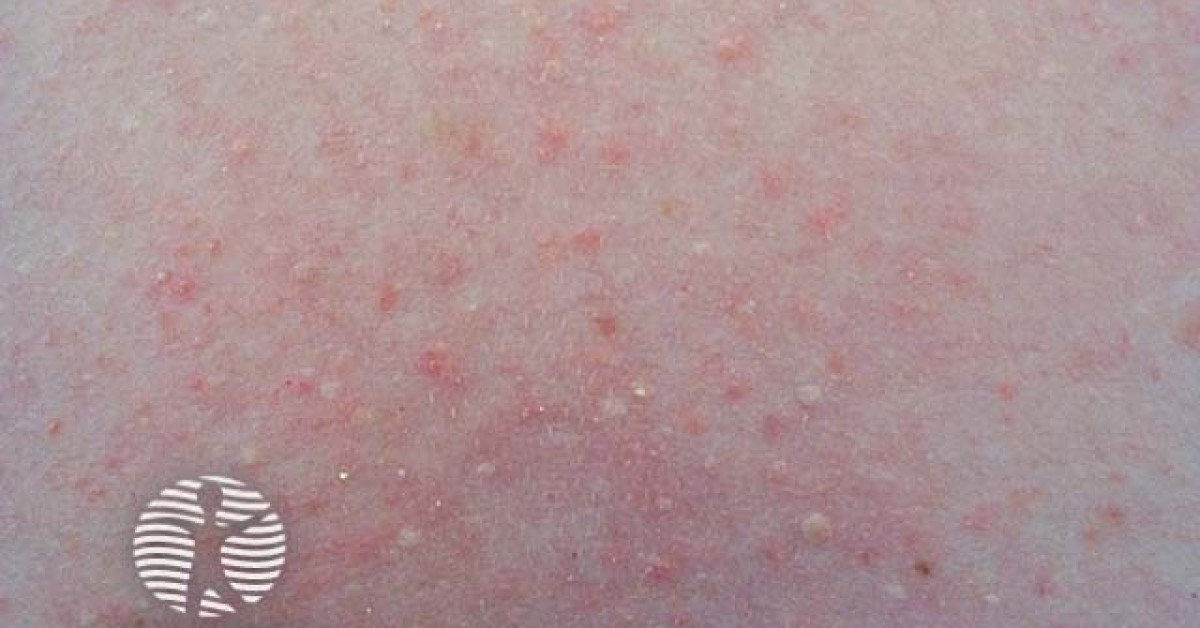 Keratosis pilaris image