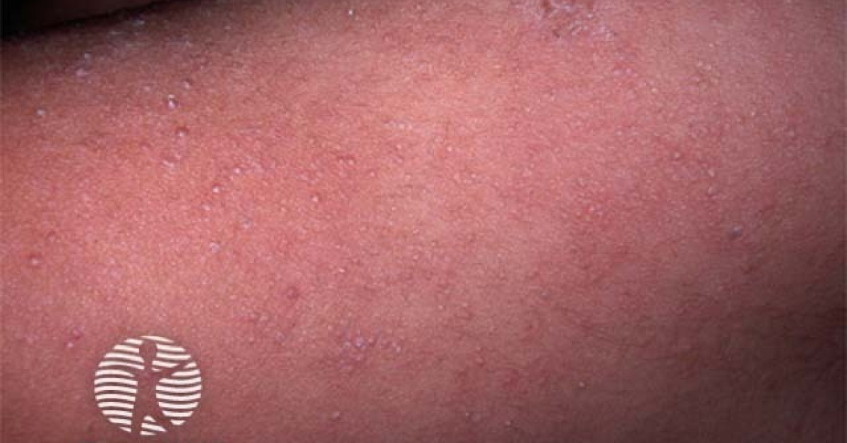 Keratosis pilaris image