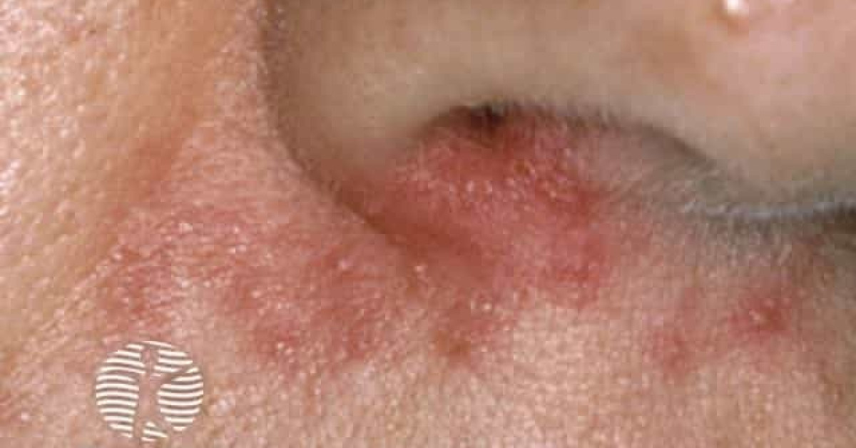 Perioral dermatitis image