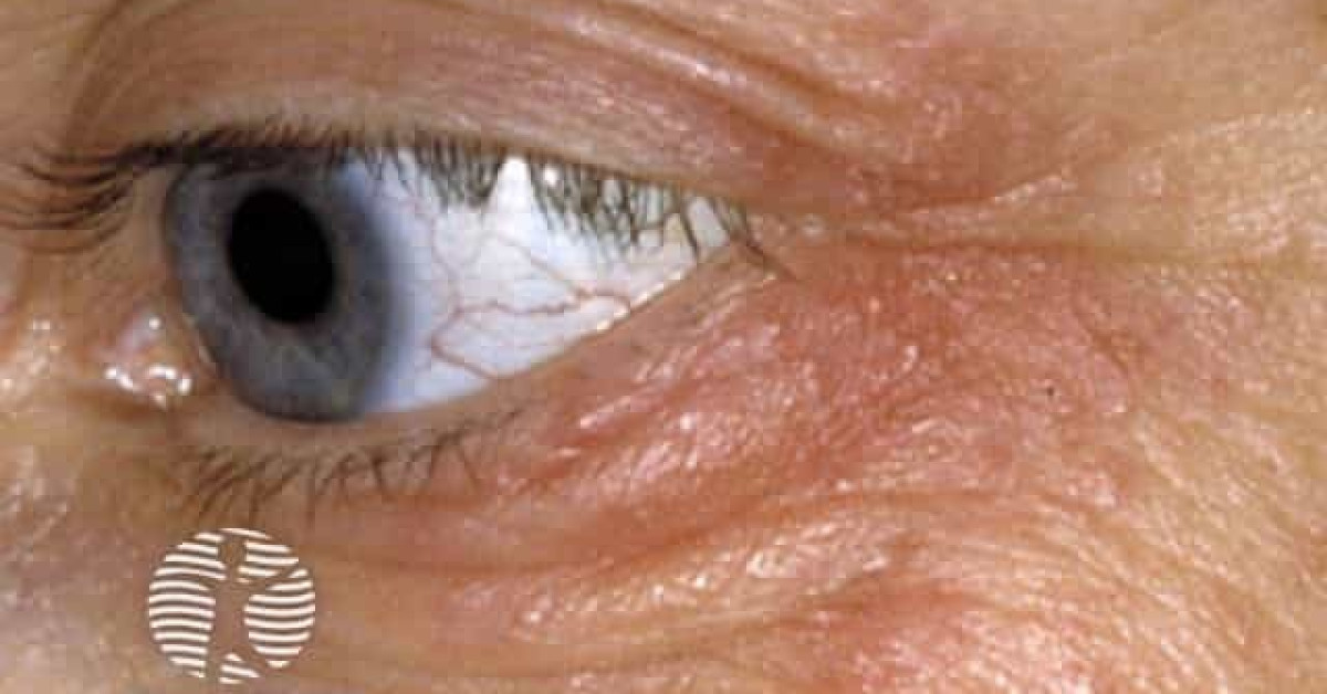 Perioral dermatitis image