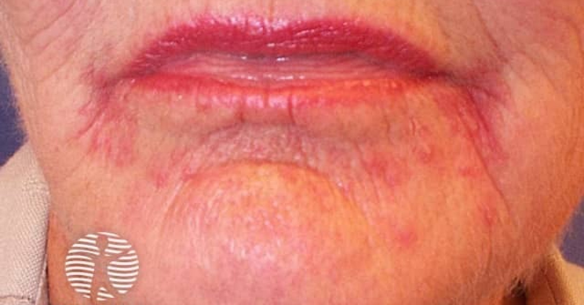 Perioral dermatitis image