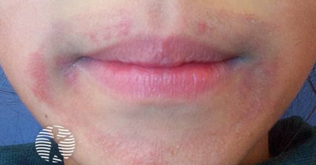 Perioral dermatitis image