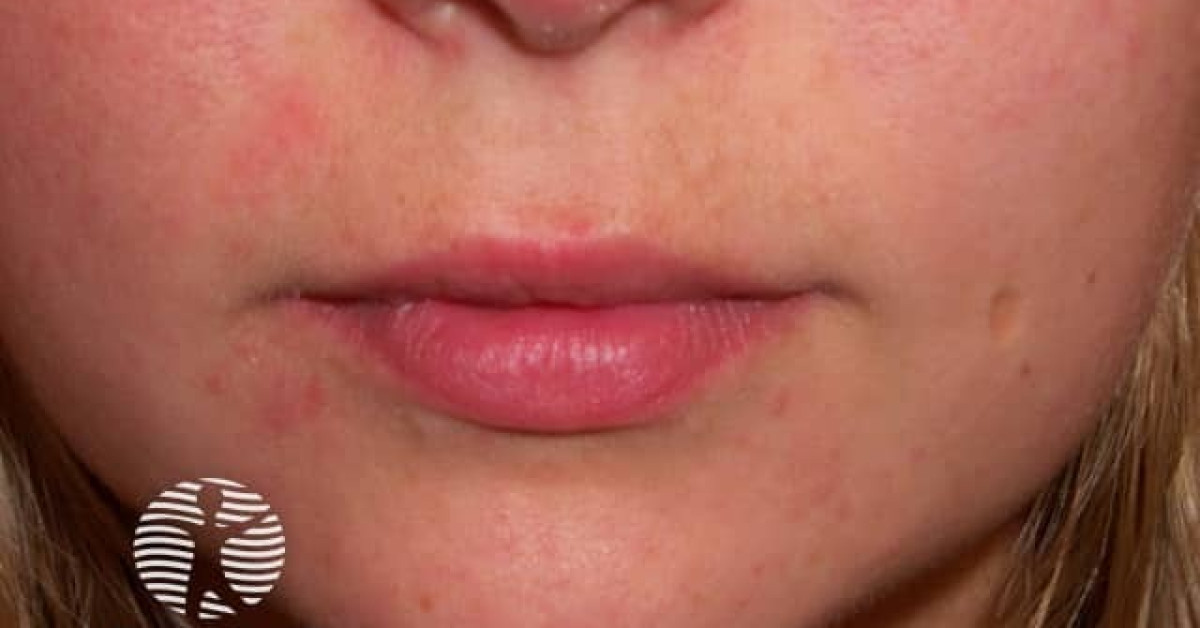 Perioral dermatitis image