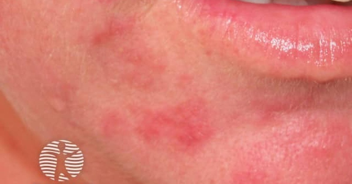 Perioral dermatitis image