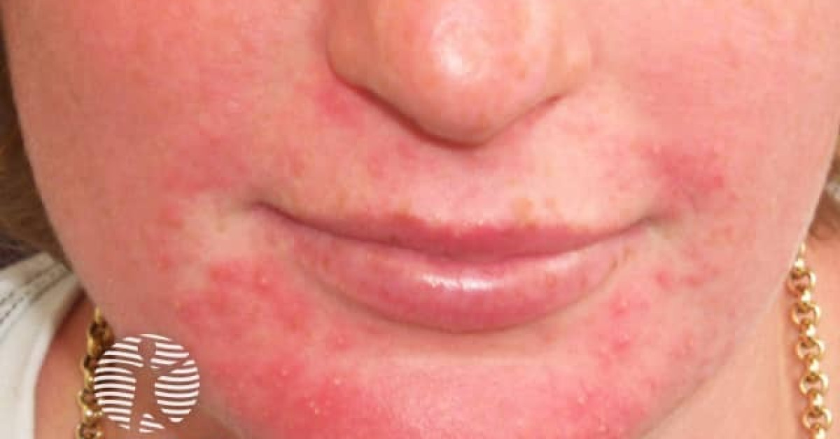 Perioral dermatitis image