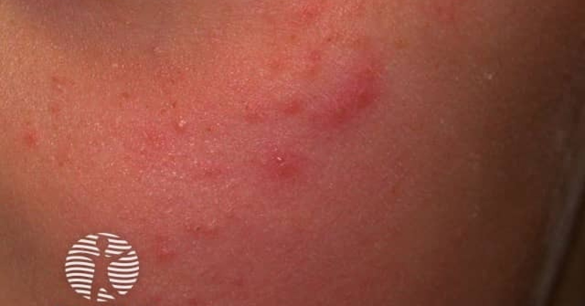 Perioral dermatitis image