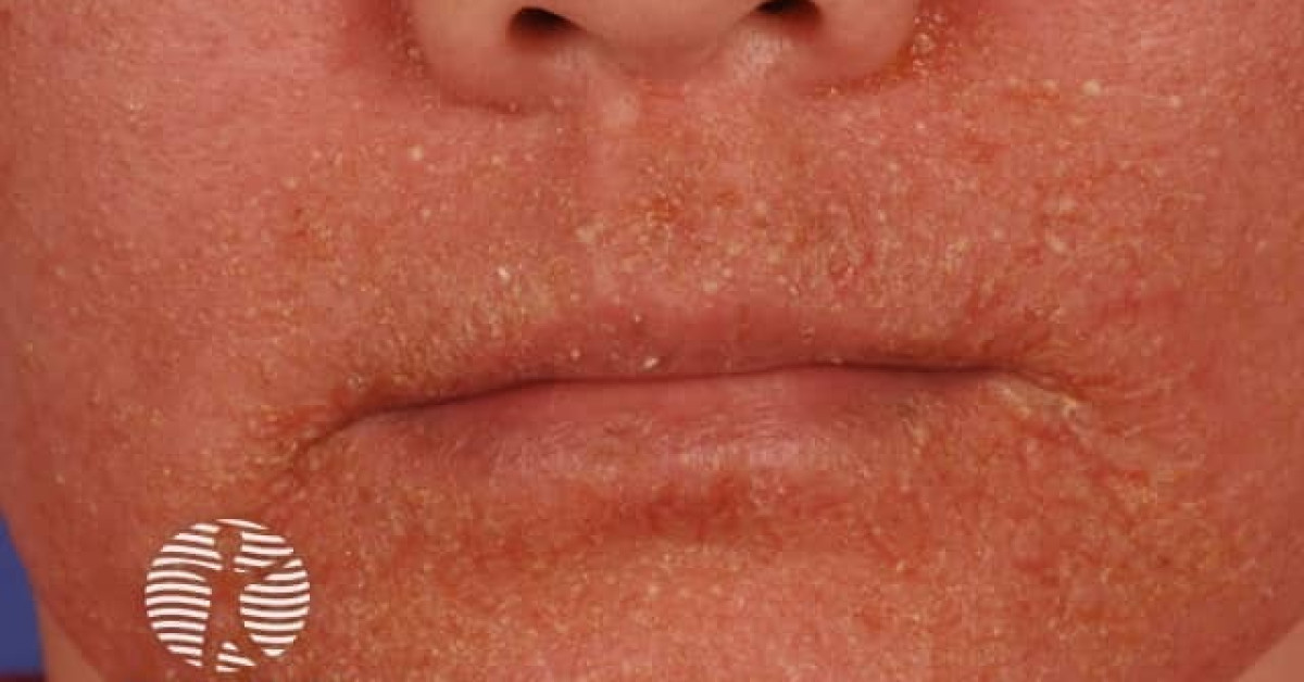 Perioral dermatitis image