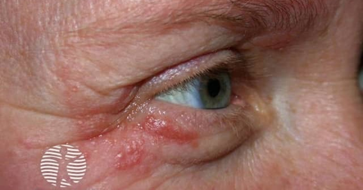 Perioral dermatitis image