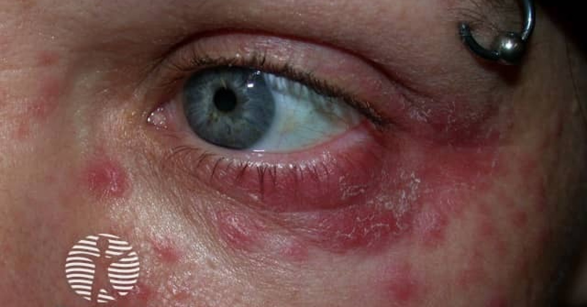 Perioral dermatitis image
