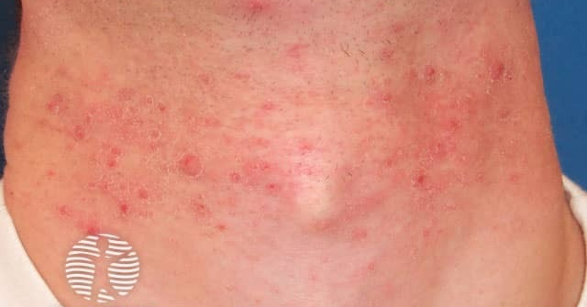 Pseudofolliculitis barbae image