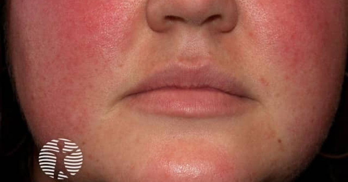Rosacea image