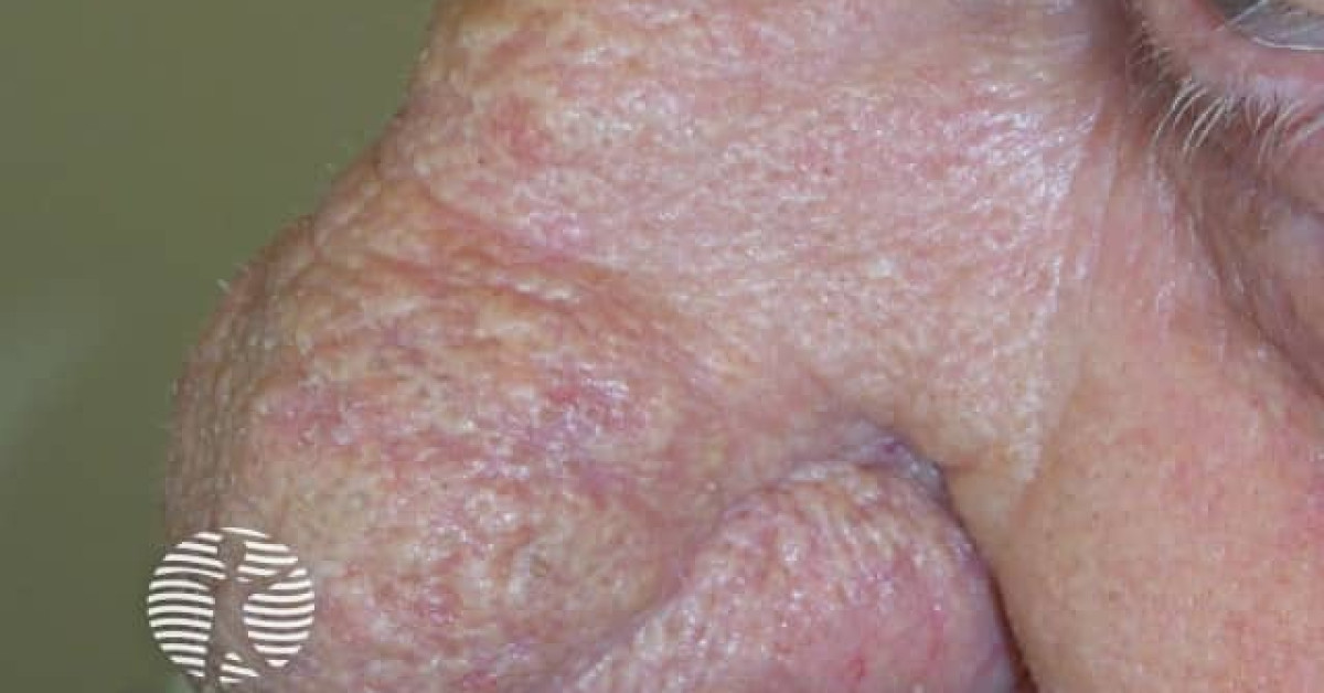 Grade 2 Rhinophyma image